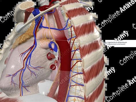Ligamentum Arteriosum Learning Radiology Calcification Ligamentum