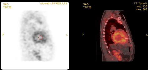 M Technetium Pyrophosphate Cardiac Single Photon Emission Computed Download Scientific Diagram