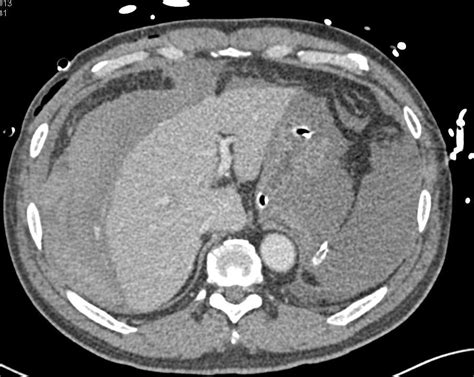 Hemoperitoneum With Underlying Cirrhosis Liver Case Studies Ctisus