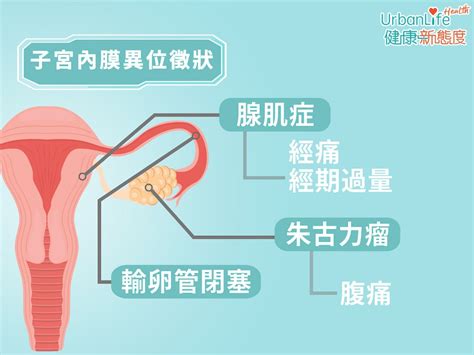 【朱古力瘤徵狀】經痛、經期過量因子宮內膜異位？波及卵巢致不孕 Urbanlife 健康新態度