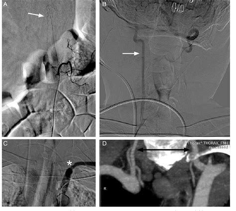 Figure 1 From Spinal Cord Ischaemia After Radical Pleurectomy