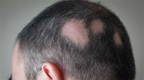 Ringworm Symptoms Pictures Treatment Diagnosis And 41 Off