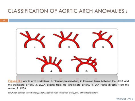 Ppt Variants Of Aortic Arch Our Experience Powerpoint Presentation
