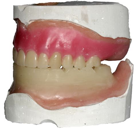 Bite Block For Partial Denture At Carole Barnes Blog