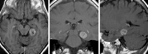 Exploring Posterior Parahippocampal Lesions The Neurosurgical Atlas Posted On The Topic Linkedin