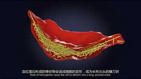 115 镰刀状细胞贫血症 腾讯视频