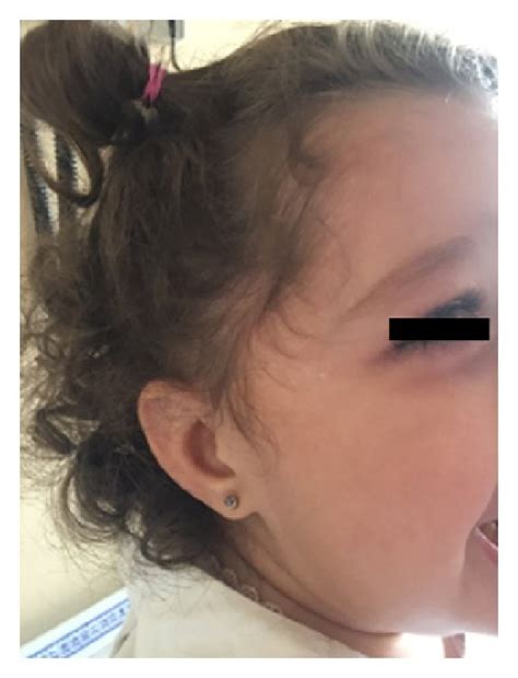 Dysmorphic Facial Features In Case Ii Download Scientific Diagram