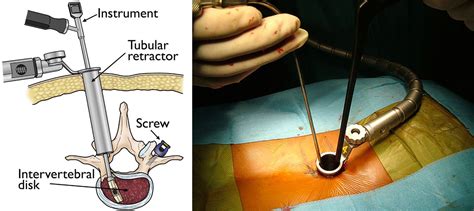 Minimally Invasive Spinal Surgery Eshealthtips