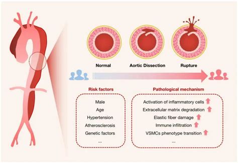 Aortic Dissection When To Hold Back On Beta Blockers Aortic