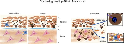 Melanocytes Melanoma