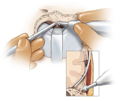 Anterior Petrosectomy The Neurosurgical Atlas