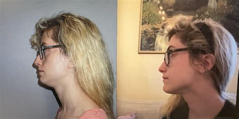 Enlarged Adenoids Face