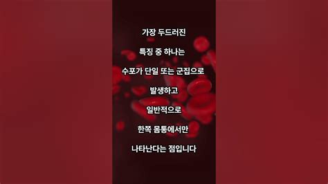 대상포진에 대해 알아 보았습니다 Shorts 대상포진 대상포진증상 Youtube