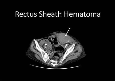 Emergency Medicine Educationhematology Archives Emdocs