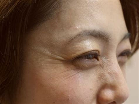 ボトックス注射の基本！シワや小顔効果を体験 美容医療 All About