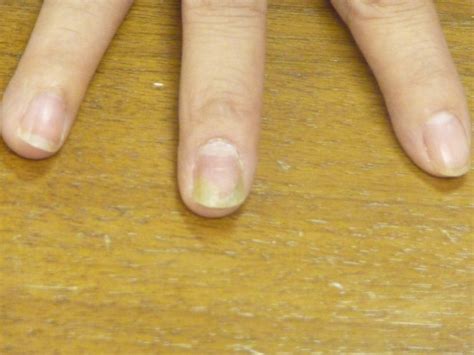 Distal And Lateral Subungual Onychomycosis