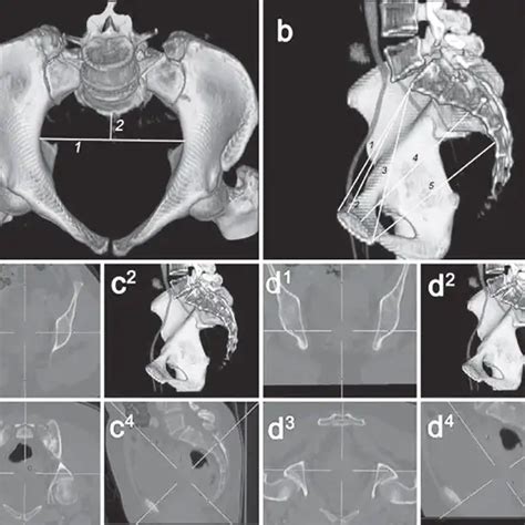 Ct Pelvis 3d Test Price In Yamuna Vihar Ganesh Diagnostic
