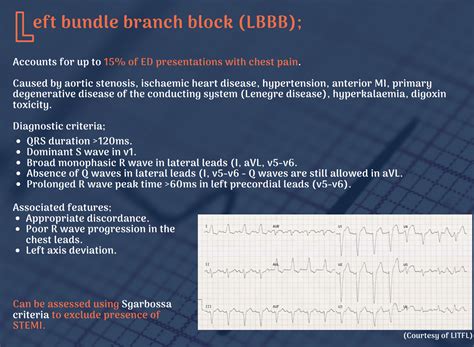 Stemi Mimics A Mnemonic V2 Fab Nhs Stuff