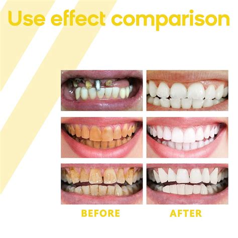 Propolis Gum Care Gel Propolis Oral Gum Repair Gel Propolis Teeth Regrowth Dental Gel Gum