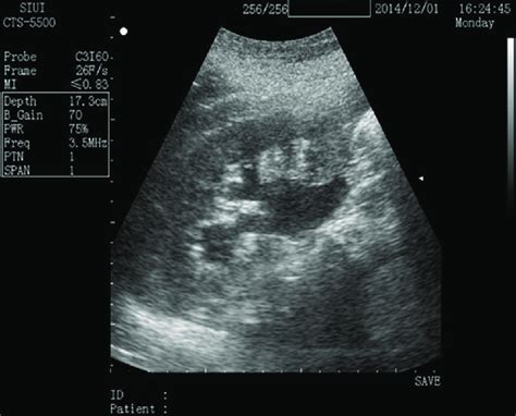 Original Two Dimensional Ultrasound Image Shows Sever Dilatation In The