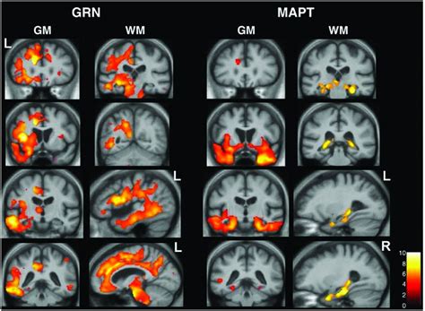 Imaging Of Frontotemporal Dementia Neupsy Key