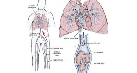 Deep Vein Thrombosis And Pulmonary Embolism Top Neuro Docs
