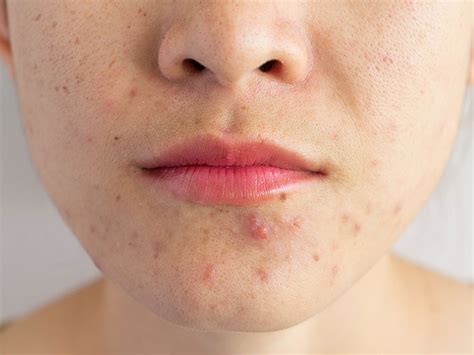 Totul Despre Acnee Cauze Preventie Si Tratament Derma Expert By Elos