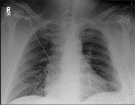 Chest X Ray Showing Mild Interstitial Prominence At The Lung Bases