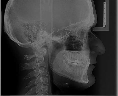 Tmj Malocclusions Myobraces And Left Aic Pattern Rtmj