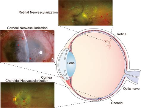 Role Of Macrophage In Ocular Neovascularization Heliyon