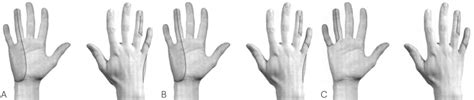 Ulnar Nerve Lesions • Litfl • Ffs