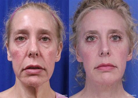 Fat Grafting Face Before And After Gallery