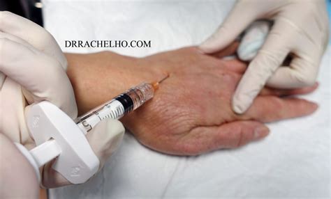 Dr Rachel Ho Hand Rejuvenation With Hybrid Cooperative Complex
