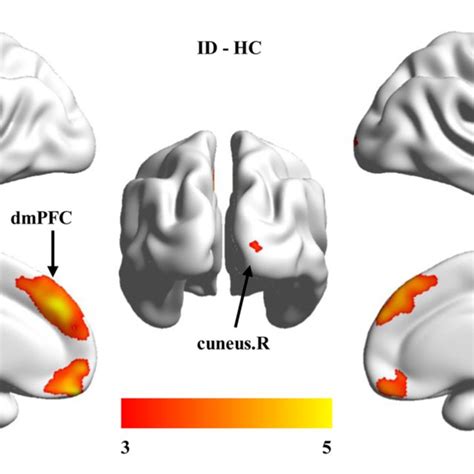 Group Differences In Gray Matter Volume Gmv Voxel Based Morphology