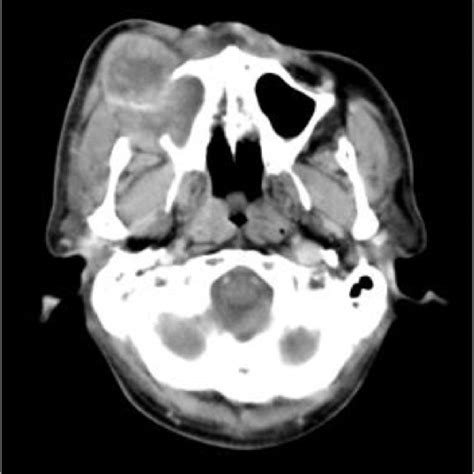Pdf A Case Of Warthin Tumors That Were Suspected To Be Lymph Node