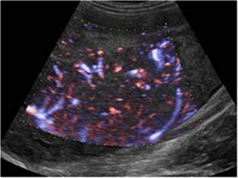 Abdomen And Retroperitoneum 1 1 Liver Case 1 1 1 Focal Nodular