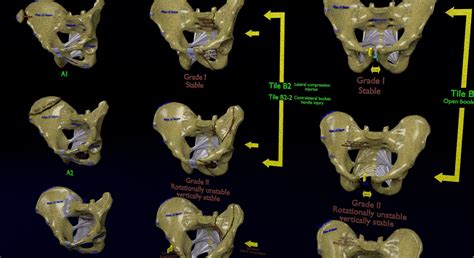 Artstation Pelvis Fractures 3d Model Resources