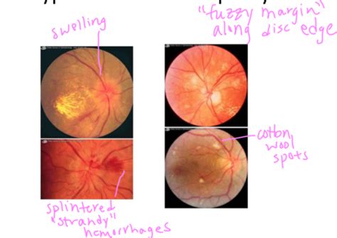 Retinal Abnormalities Flashcards Quizlet