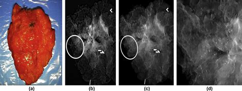 Intraoperative Digital Breast Tomosynthesis Using A Dedicated Device Is