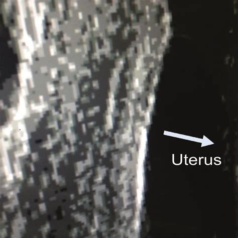 Pdf Radiological Imaging Of Disorders Of Sex Development Dsd