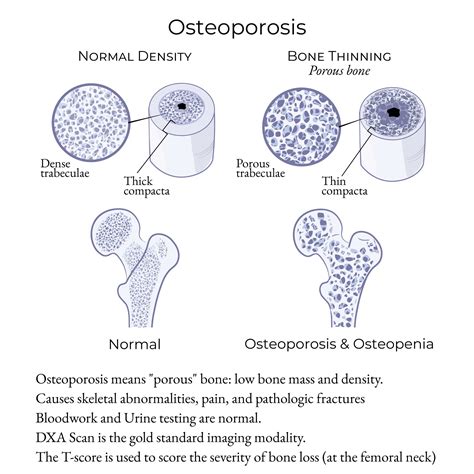 Clinical Medicine Glossary Osteoporosis Ditki Medical And Biological