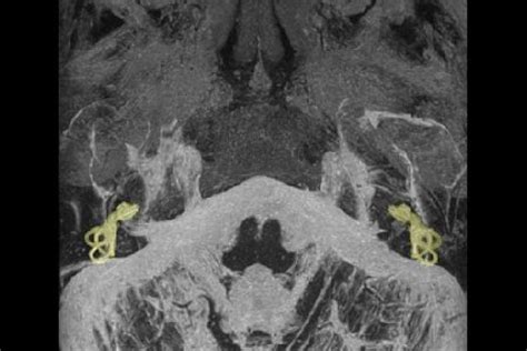Ai Tool For The Fully Automated Segmentation Of The Inner Ear On News Maastricht University