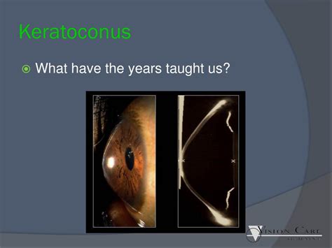Ppt Keratoconus And Specialty Contact Lens Fitting Of Irregular