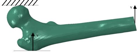 Figure 1 From Bone Fracture Analysis Using The Extended Finite Element
