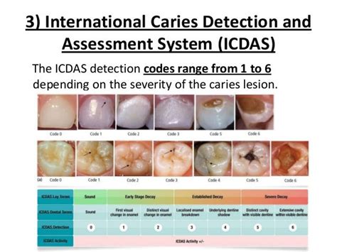 Icdas Caries Classification