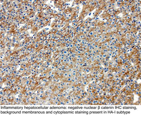 Pathology Outlines Hepatocellular Adenoma