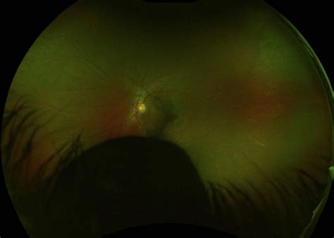 Fundus Photo Of The Left Eye Showing A Peripheral Darkly Pigmented