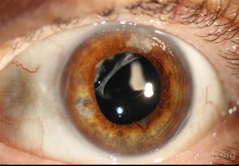 Anterior Chamber Cilium
