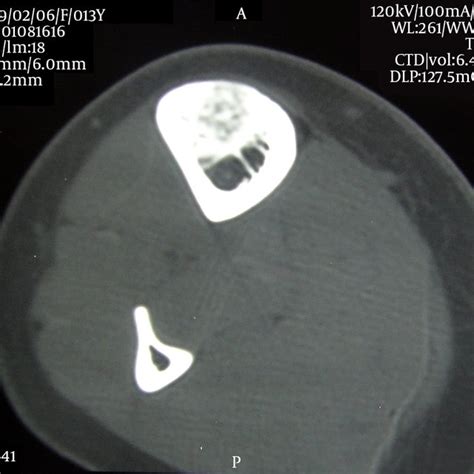 Axial Cut Of Ct Scan Of Adamantinoma Of Tibia Download Scientific Diagram