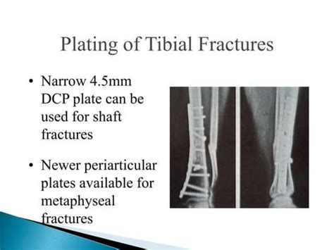 Both Bone Leg Orthopedics Powerpointpptx Pptx